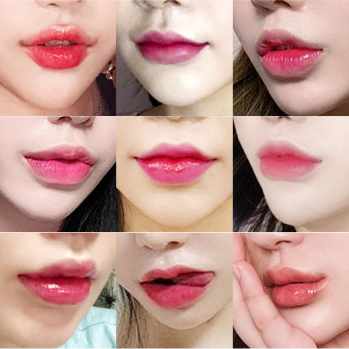 MINE Bedah Plastik | Filler Bibir Dan Mengangkat Sudut Bibir