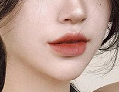 MINE Bedah Plastik | Filler Bibir & Botox Sudut Bibir