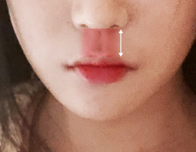 MINE Bedah Plastik | Filler Bibir & Botox Sudut Bibir