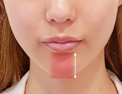 MINE Bedah Plastik | Filler Bibir & Botox Sudut Bibir