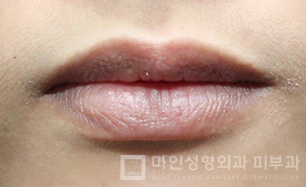 MINE Bedah Plastik | Filler Bibir & Botox Sudut Bibir